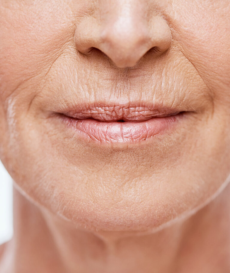 Wrinkles Treatment | Wellesley, MA | MD TLC™